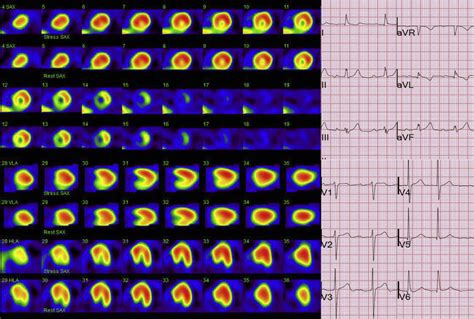 How To Read Myocardial Perfusion Scan At Aiden Ligar Blog