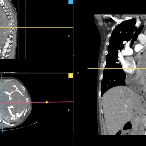 Intraoperative View Of Clamshell Approach Download Scientific Diagram