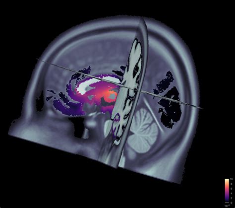Whole Brain Source Analysis Fft And Mni Space Discussions Brainstorm