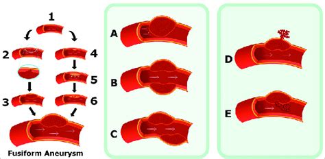 Fusiform Aneurysm Pathogenesis 1 Normal Intracranial Vessel 2 Download Scientific Diagram