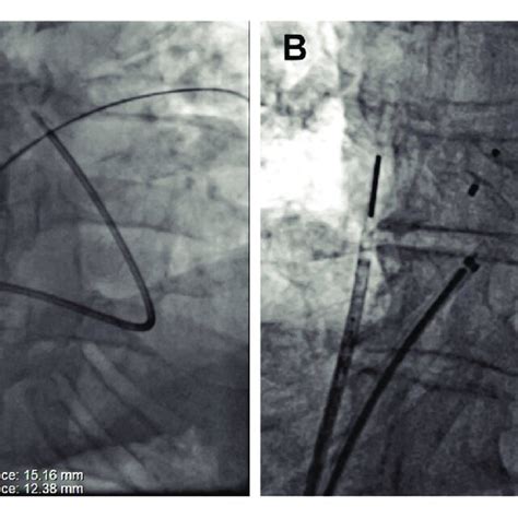Panel A Pfo Occlusion Test Performed By Inflating Sizing Balloon On Download Scientific
