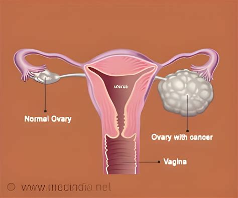 At Home Swab Tests For Endometrial And Ovarian Cancer Detection