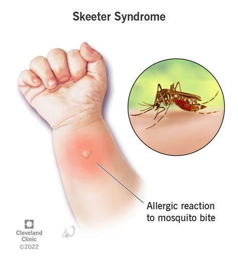 Terrifying Mosquito Bite Symptoms You Cant Ignore Learn Quick Treatment Tips Now