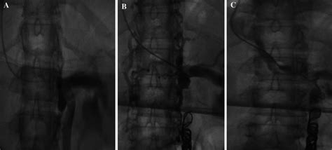 Female Pelvic Vein Embolization Indications Techniques And Outcomes