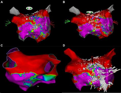 Pulsed Field Ablation Using Pentaspline Catheter As A Bail Out Strategy For Perimitral Flutter