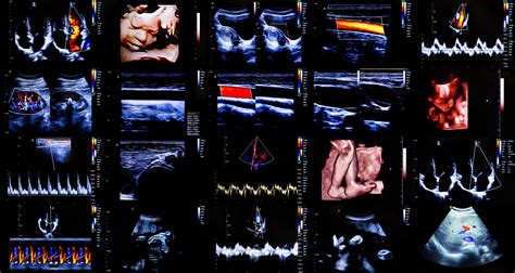 Ultrasound Elastography For Surgery Precision Open Medscience