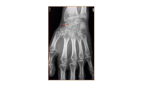 Mdk Syndrome Douloureux Régional Complexe De Type 1