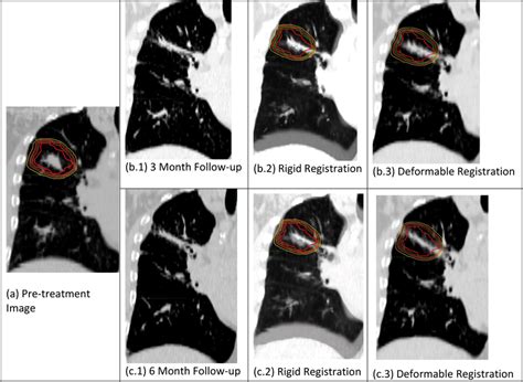 Example Of Image Registration A Baseline Pre‐treatment Used For Download Scientific Diagram
