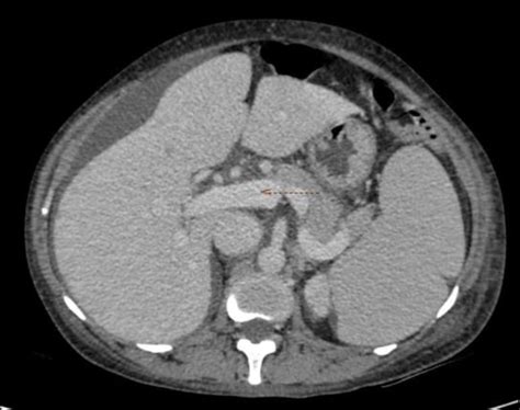 Telangiectatic Spot Noted In The Tongue Download Scientific Diagram