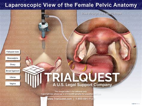 Laparoscopic View Of The Female Pelvic Anatomy Trial Exhibits I