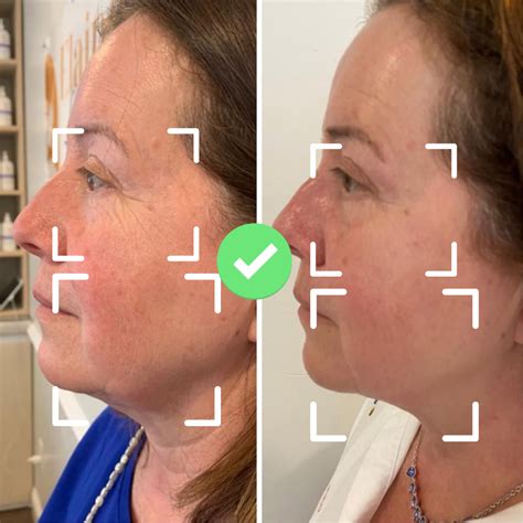 How Does Ultraformer Iii Work Elaine Medspa