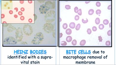 Heinz Bodies And Bite Cells