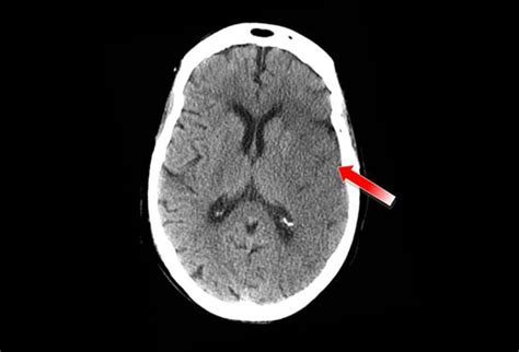 Acute Stroke Critical Findings And Management