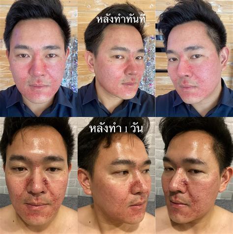 ก่อนและหลังทำเลเซอร์ Pico Laser ต้องปฏิบัติตัวอย่างไรบ้าง ให้ผลลัพธ์ออกมาดีที่สุด Attitude