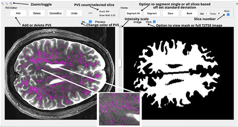 Frontiers Semi Automated Segmentation And Quantification Of Perivascular Spaces At 7 Tesla In