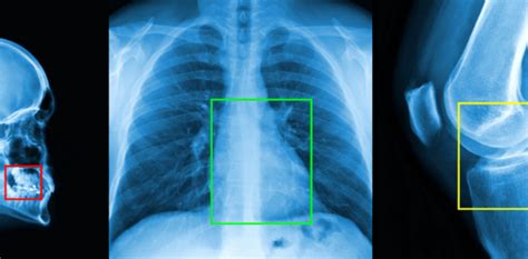 Computer Vision In Healthcare Imagevision Ai
