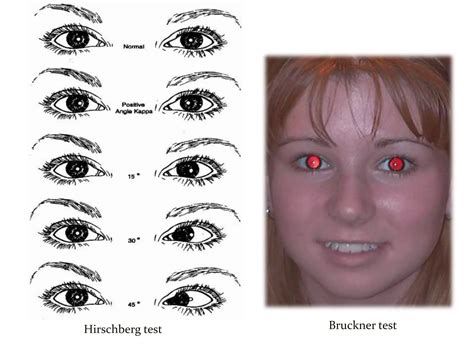 Amblyopia Classification And Management Modified Pptx