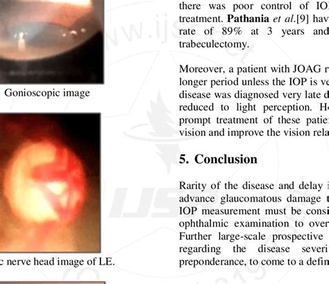 Trabeculectomy Bleb On Postoperative Day 7 Download Scientific Diagram