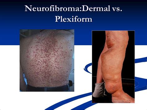 Understanding Neurofibromas Types And Appearance
