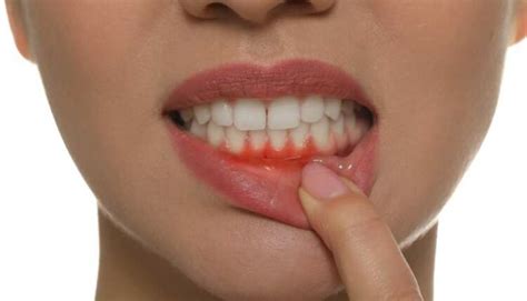 ¿qué Es La Estomatitis Diario RoatÁn