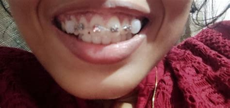 Braces Treatment Gone Wrong Rorthodonticvictims