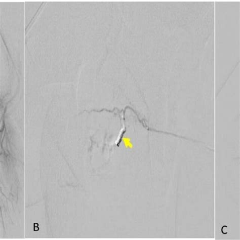 A Penile Arteriography With Digital Arterial Subtraction DSA Shows