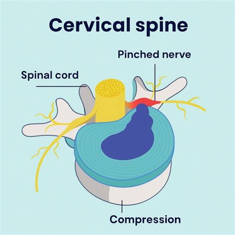 Cervical Radiculopathy Personalized Non Surgical Relief