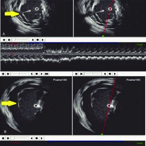 Intracardiac Echography Using A Rotational Probe A The Viewflex