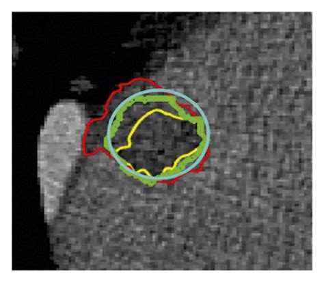 3d Liver Tumor Segmentation Using Drls And Fls In Comparison Ad
