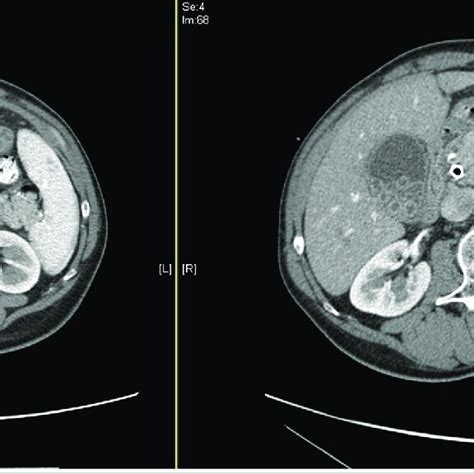 Abdominal Ct Scan Multiple Cholelithiasis With Acute Cholecystitis