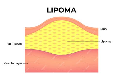 Premium Vector Lipoma Vector Illustration