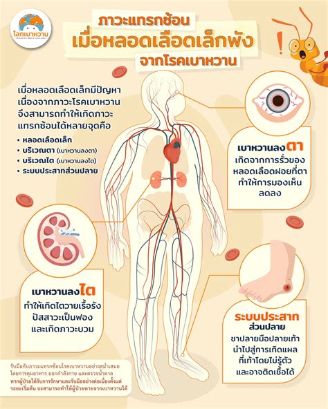 โลกเบาหวาน ภาวะแทรกซ้อน