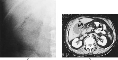 Emphysematous Cholecystitis Semantic Scholar