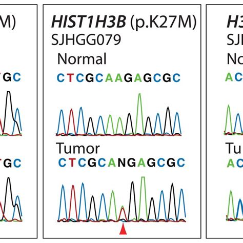 Recurrent Somatic Mutations In H3f3a And Hist1h3b Sanger Sequencing Download Scientific Diagram
