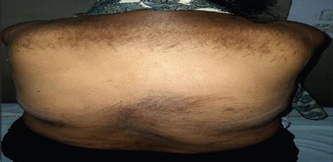 Ribociclib Induced Flagellate Rash Cancer Research Statistics And