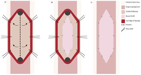 Non Transecting Urethroplasty For Bulbar Urethral Strictures—narrative Review And Treatment