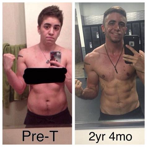 Ftm Before And After