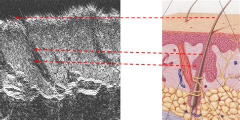 Dermatology Ultrasound Non Invasive Screening Assessment Of Melanoma Skin Lesions Skin
