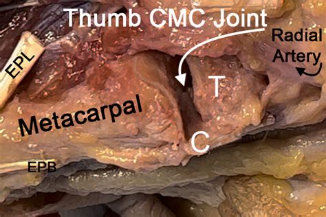 Thumb Cmc Basilar Joint Anatomy Anatomic Structures At Risk
