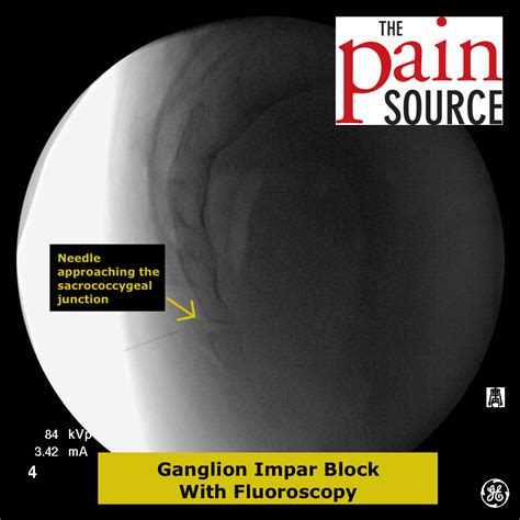 Ganglion Impar Block With Fluoroscopy The Pain Source Makes Learning About Pain Painless