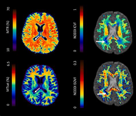example parametric maps for a person with recently diagnosed