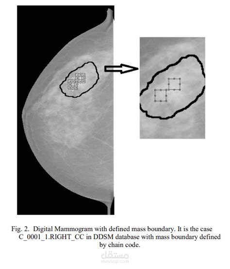 computer aided diagnosis system for classification of masses in digital
