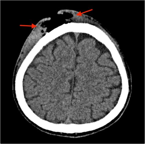 Scalp Myiasis The Patient Was Whacked On The Head By A Falling Tree