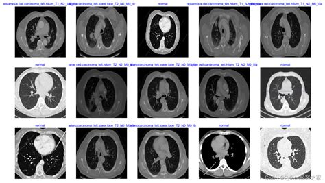 基于深度学习的ct影像肺癌检测识别本项目旨在开发一套基于深度学习的ct图像病灶检测识别系统。 Csdn博客