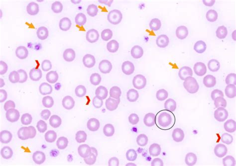 06 Non Regenerative Anemias Flashcards Quizlet