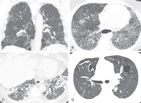 Diffuse Lung Diseases Clinical Tree