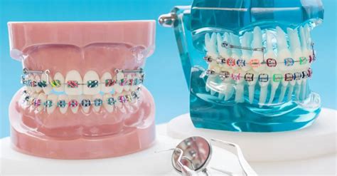 Guide To The Different Types Of Braces And It S Costs