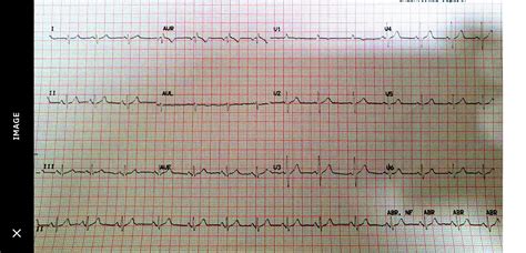 Does My Ecg Show Wpw Syndrome Raskdocs