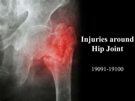 Hip Joint Anatomy Physiology And Injuriespptx