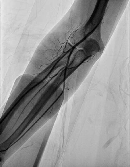 Figure 3 From Transradial Carotid Artery Stenting In A Patient With